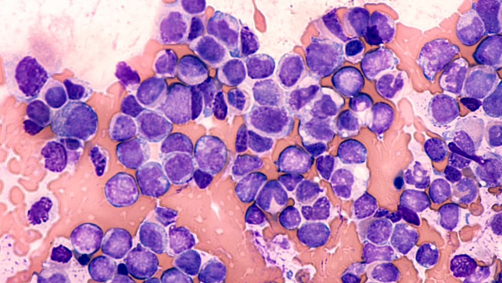 New drug for myeloid leukemia - Aesthetic Medical Practitioner