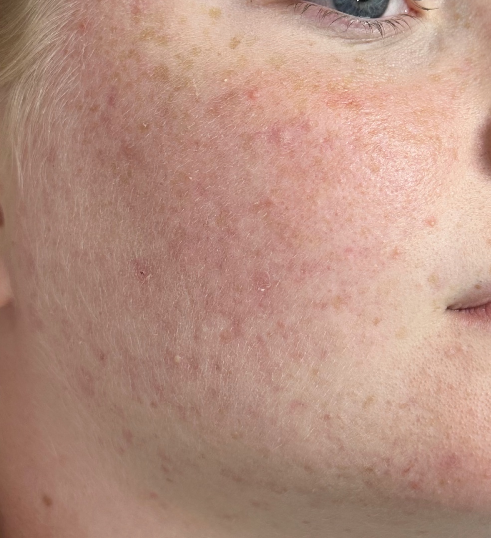 Take your microneedling results to the next level with EXCEED ...