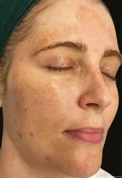 Alma Harmony XL Pro - Aesthetic Medical Practitioner