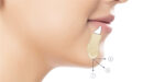 Why the lower third is key to facial aesthetics - Aesthetic Medical ...