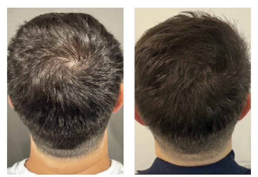 Simplifying transdermal serum delivery in aesthetic practice ...