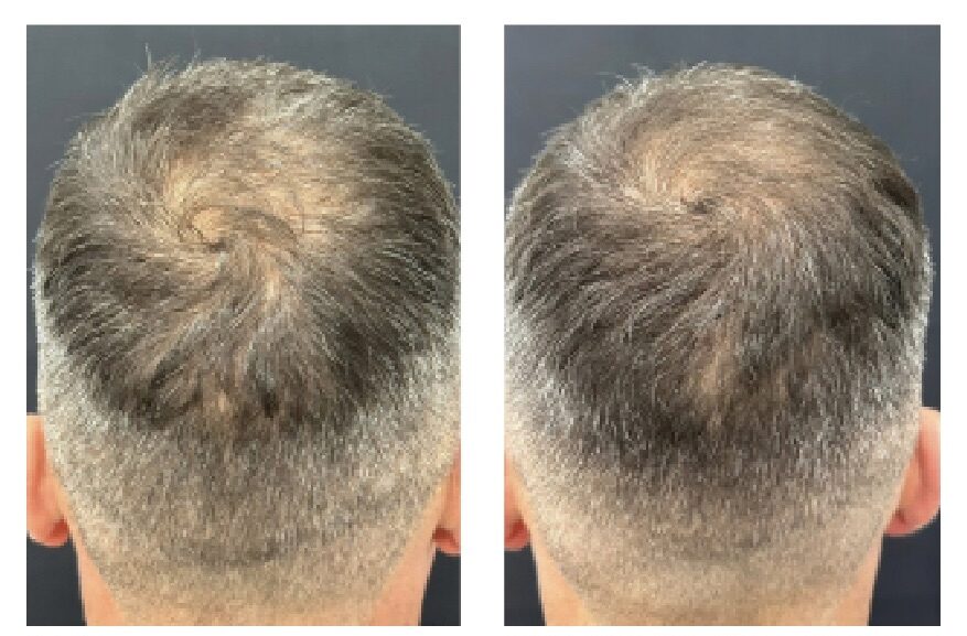 Simplifying transdermal serum delivery in aesthetic practice ...