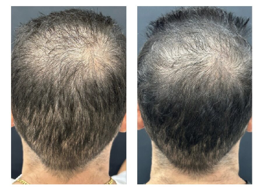 Simplifying transdermal serum delivery in aesthetic practice ...